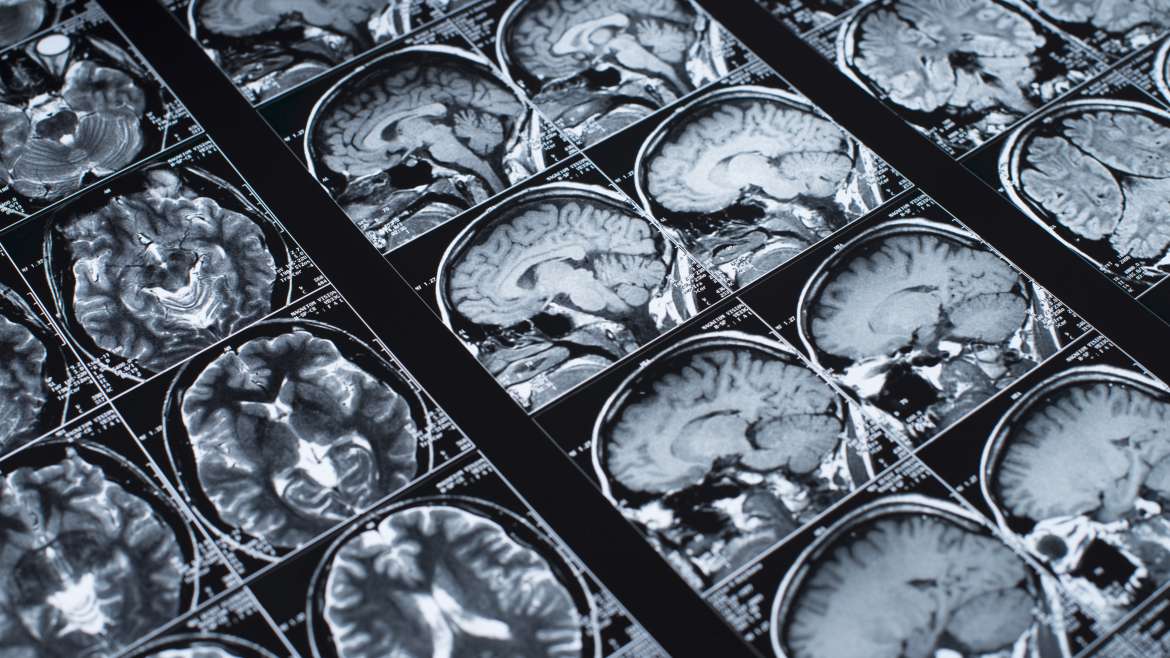 Neurolaw in the courtroom is on the rise | Precise Digital